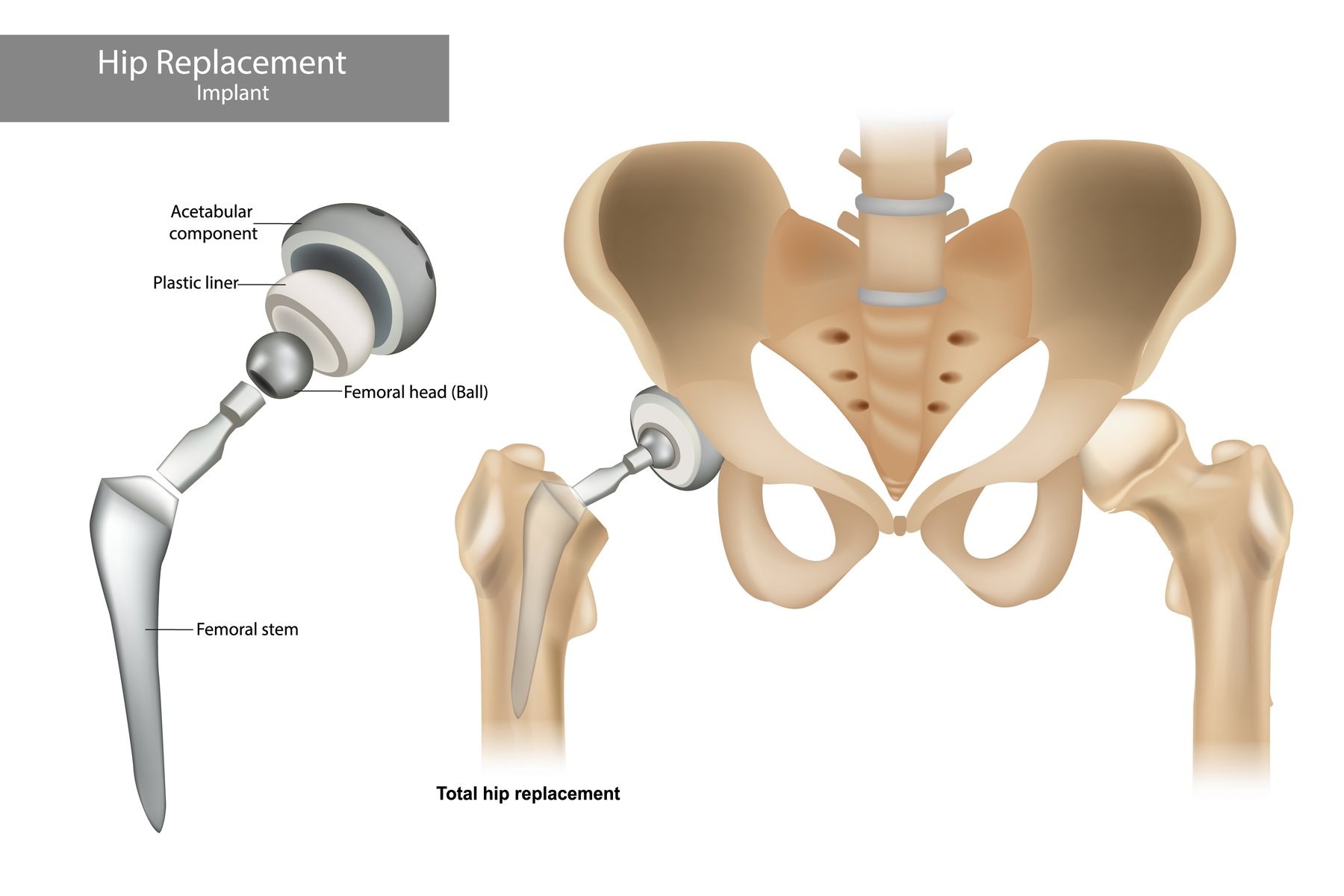 Labrum Repair vs. Total Hip Replacement: Procedures, Recovery, and Physical Therapy